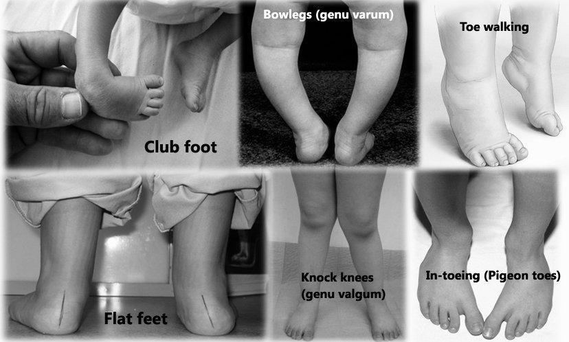 Pigeon Toed And Bow Legged